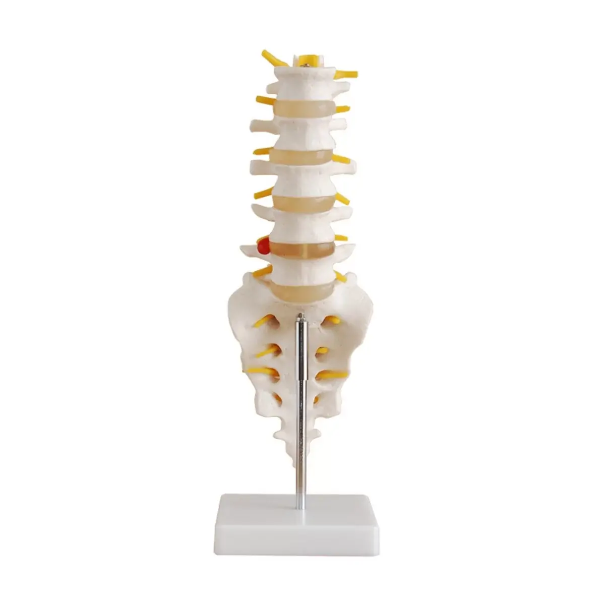 Lumbar Vertebrae With Sacrum, Coccyx and Herniated Disc (Life-Size ...